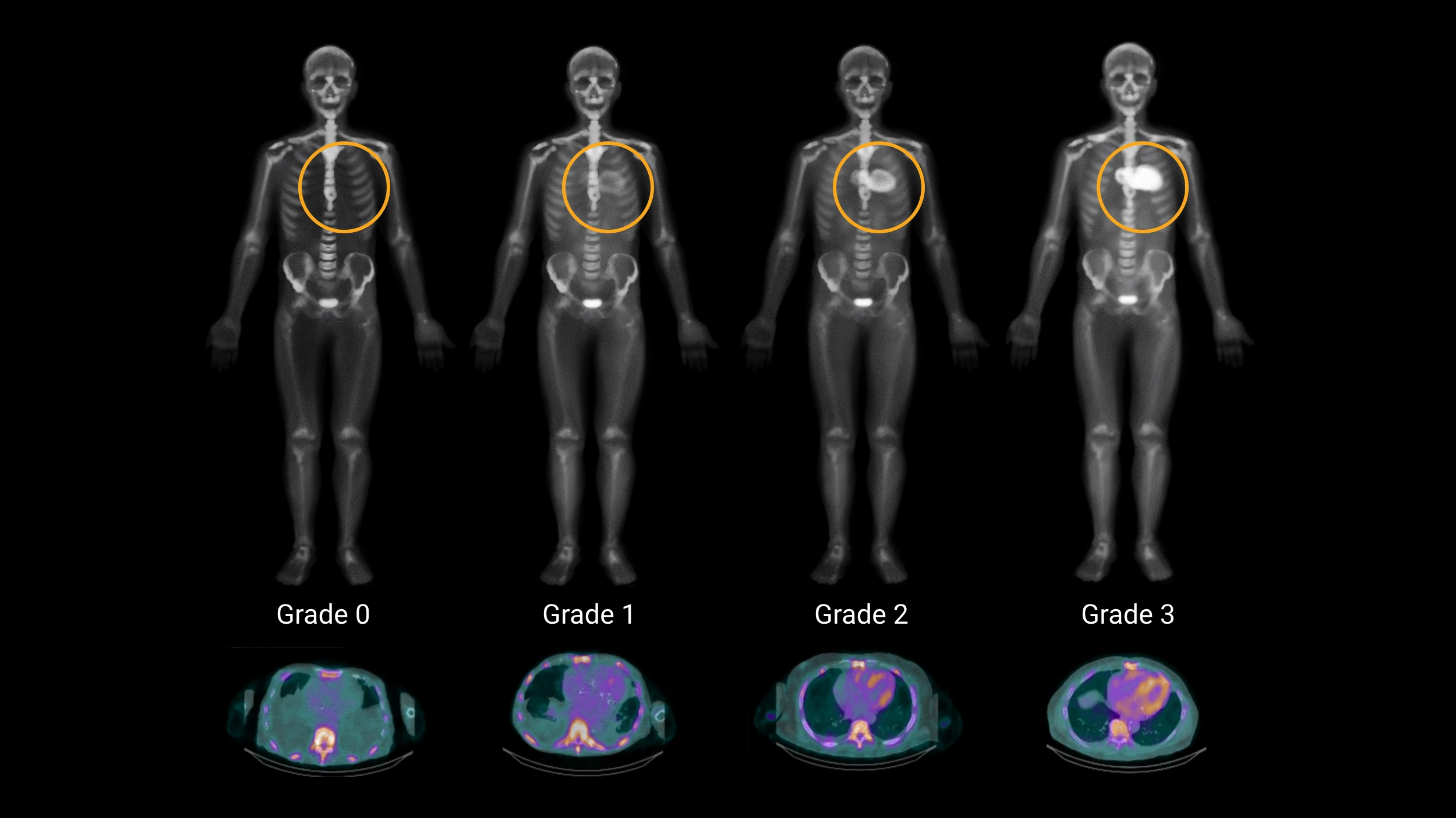 Lesson 2: Nuclear Imaging in ATTR-CM: Scintigraphy and the Role of ...
